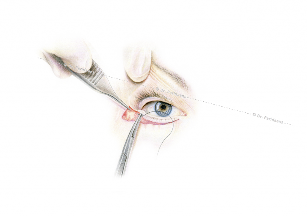 Lateral canthopexy: a crucial step in cosmetic lower blepharoplasty ...