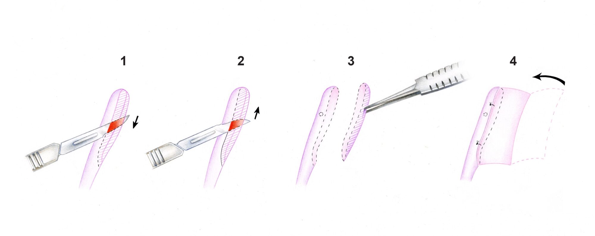 Modified DCR surgery for patients with a tearing eye: Medial lacrimal ...